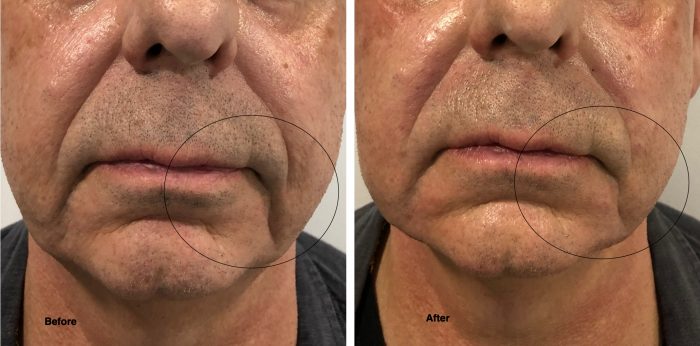 PDO Thread Lift Adelaide | epiclinic® Cosmetic Clinic